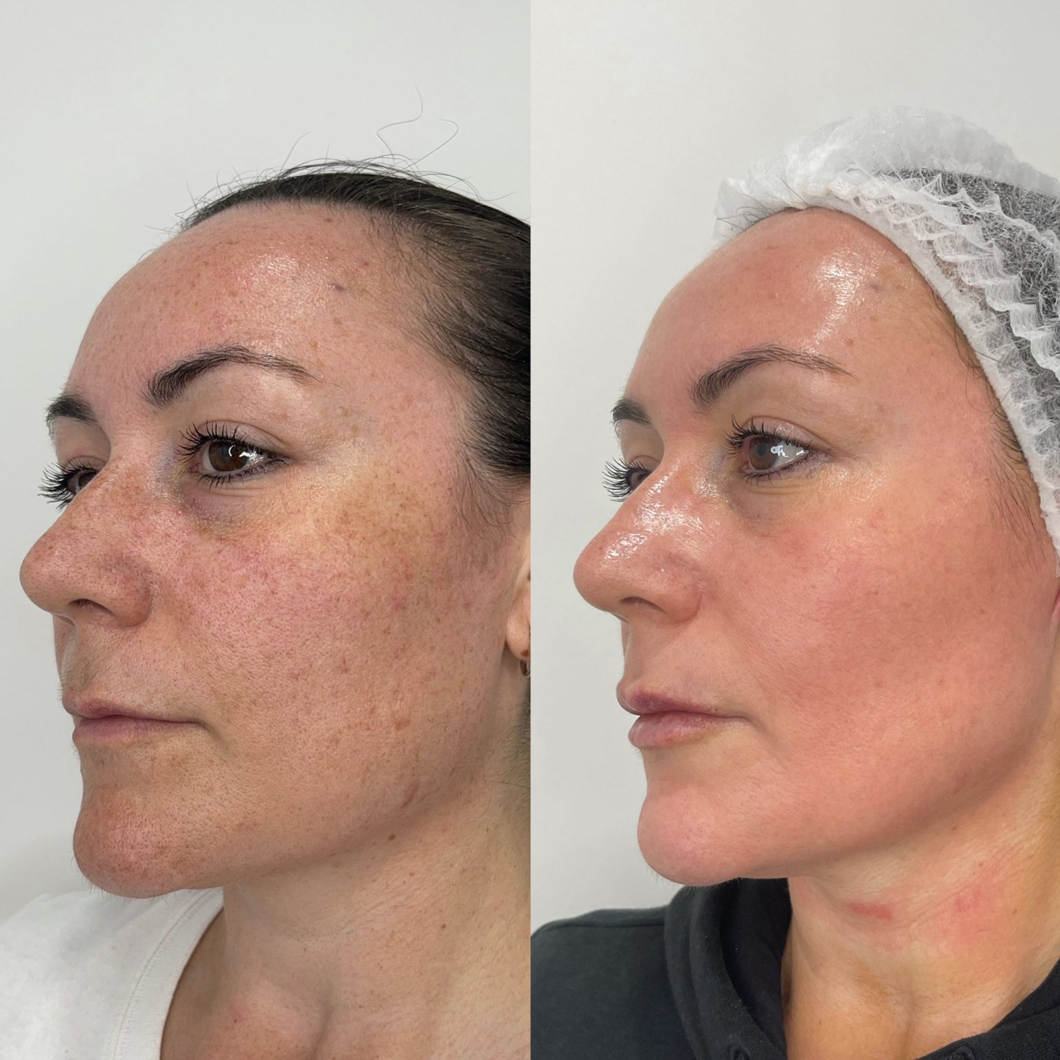 Reduce Hyperpigmentation with Cosmelan | The Cosmetic Lounge
