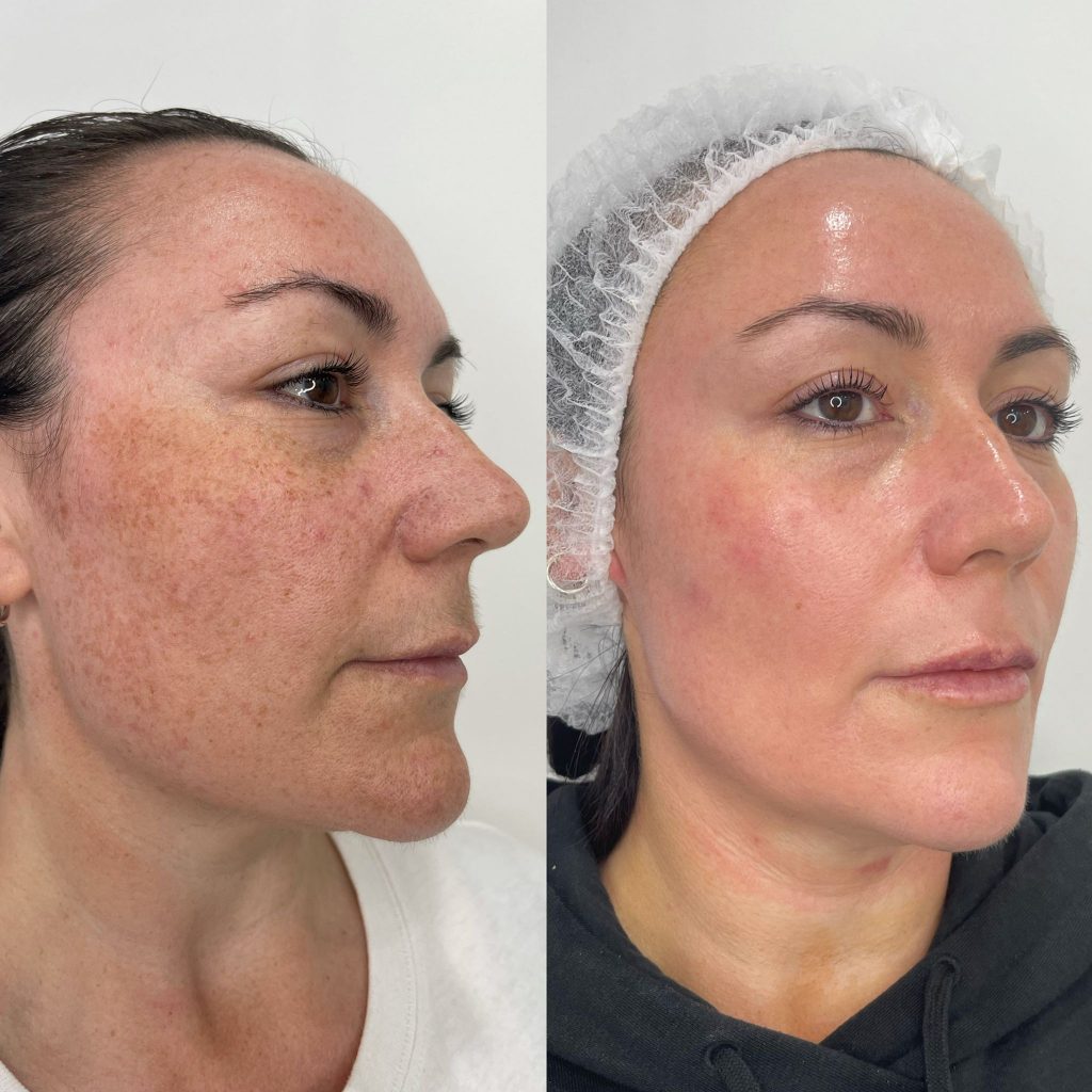 Reduce Hyperpigmentation with Cosmelan | The Cosmetic Lounge