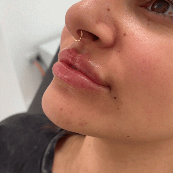 Explore Our Lip Treatment in Sydney | The Cosmetic Lounge