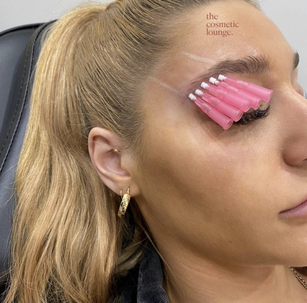 Fox Eyes Treatment In Australia | The Cosmetic Lounge