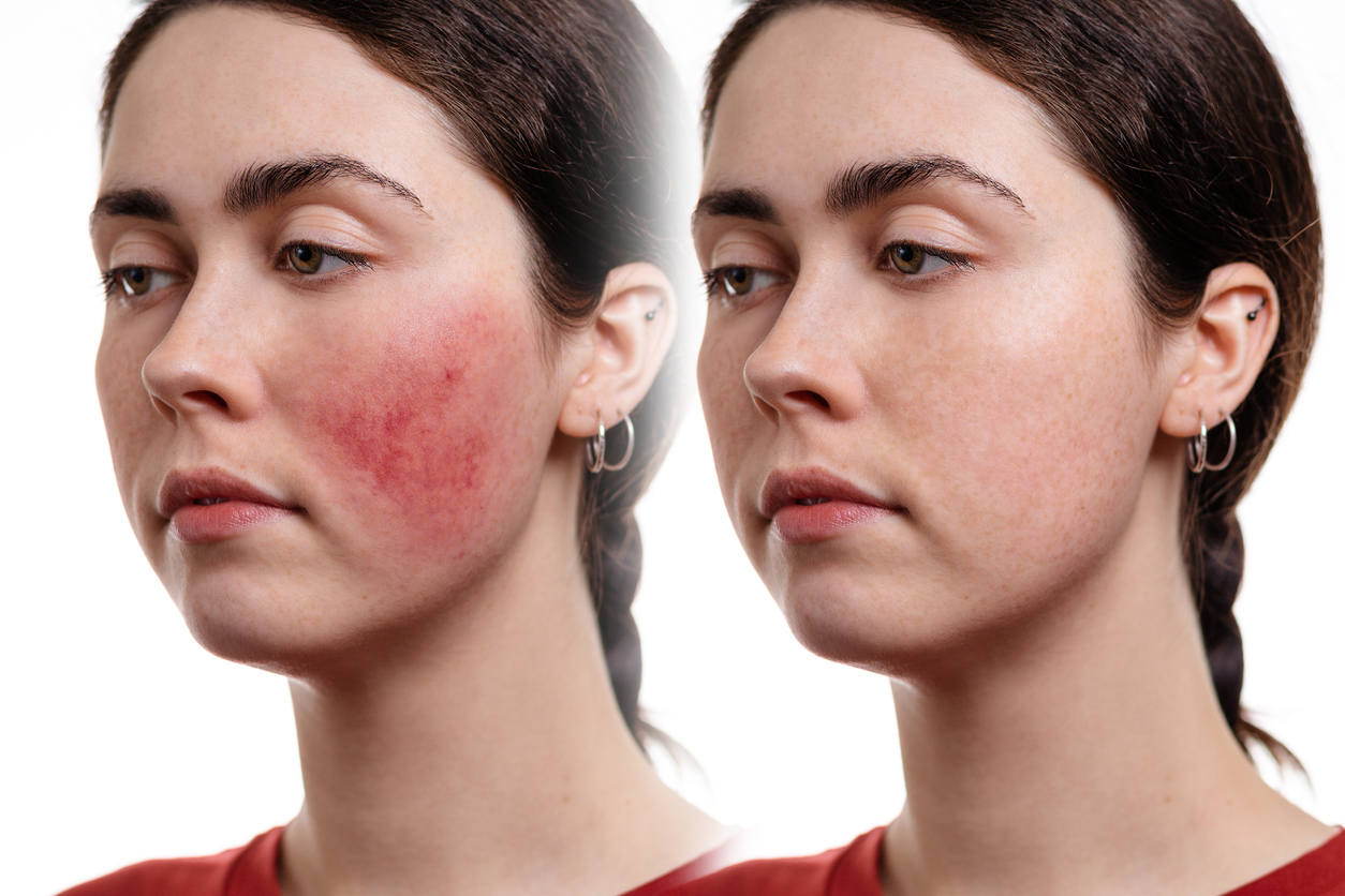 Cosmetic Injectables for Rosacea Treatment | The Cosmetic Lounge