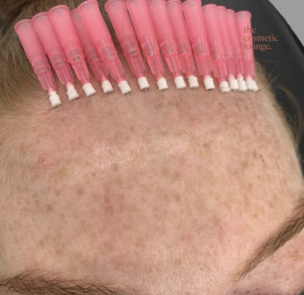 Tighten Skin with PDO Threads Treatment | The Cosmetic Lounge