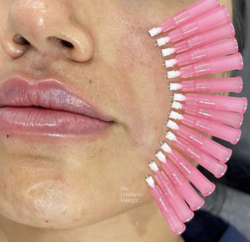 Tighten Skin with PDO Threads Treatment | The Cosmetic Lounge